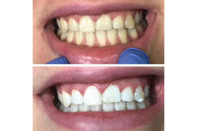 Teeth Whitening | Centre Dentaire Ville De Quebec
